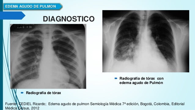 Edema agudo pulmon