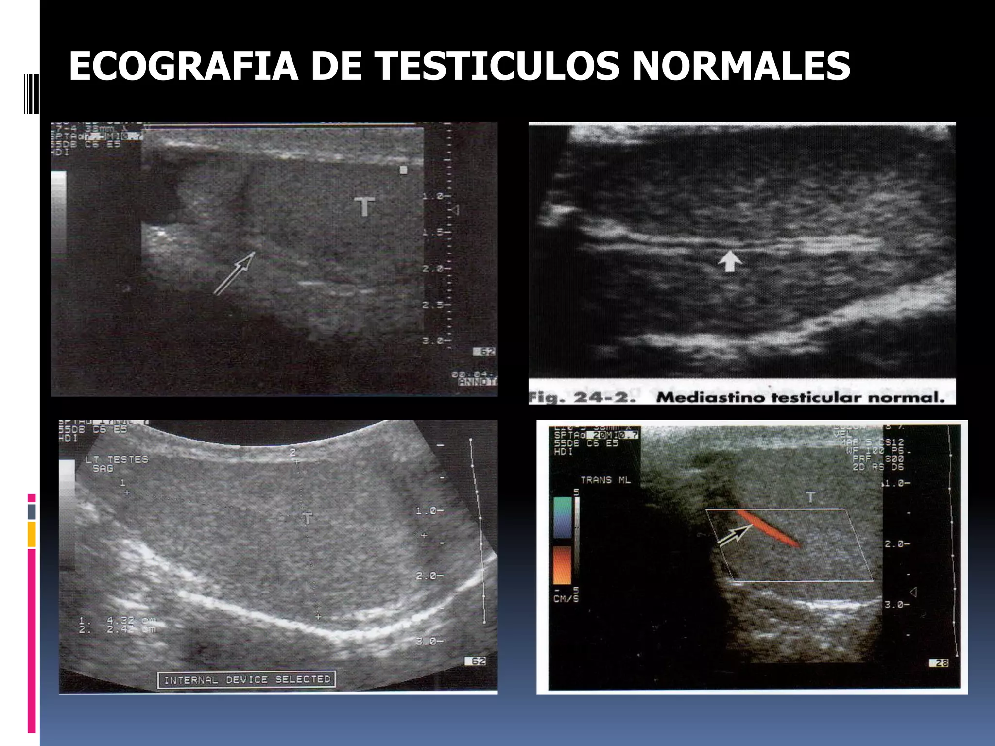 Ecografia escroto y testiculo | PDF
