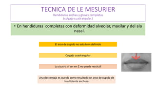 Presentacion fisura labial y palatina | PPTX