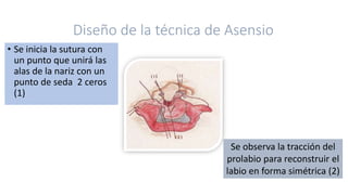 Presentacion fisura labial y palatina | PPTX