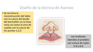 Presentacion fisura labial y palatina | PPTX