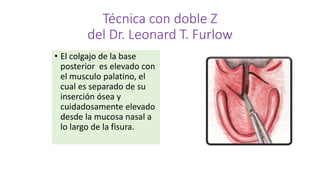 Presentacion fisura labial y palatina | PPTX