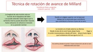 Presentacion fisura labial y palatina | PPTX