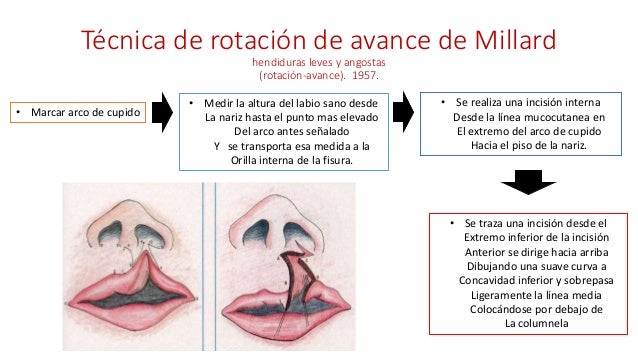 Presentacion fisura labial y palatina