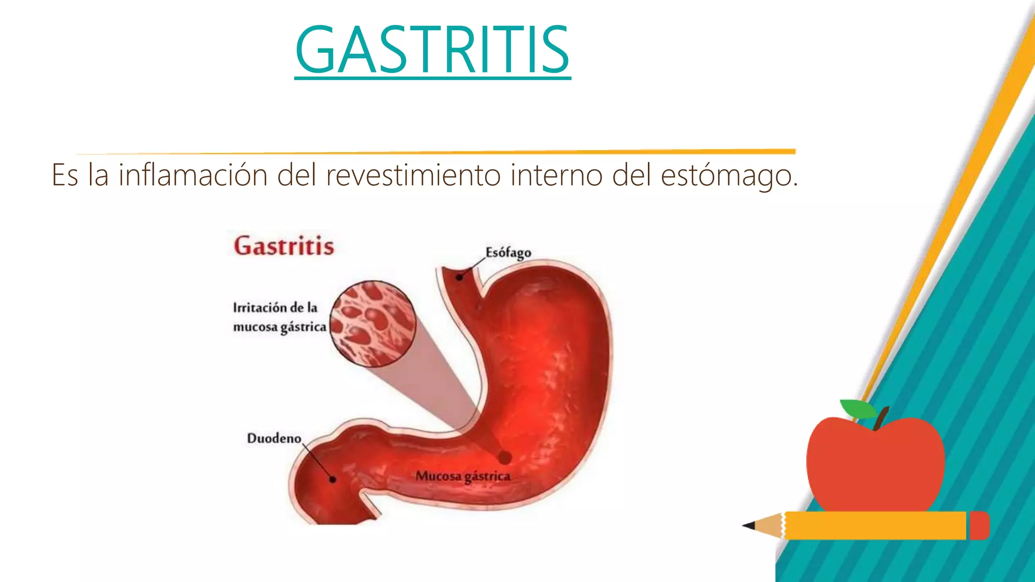 Presentacion gastritis y gastroenteritis | PPTX