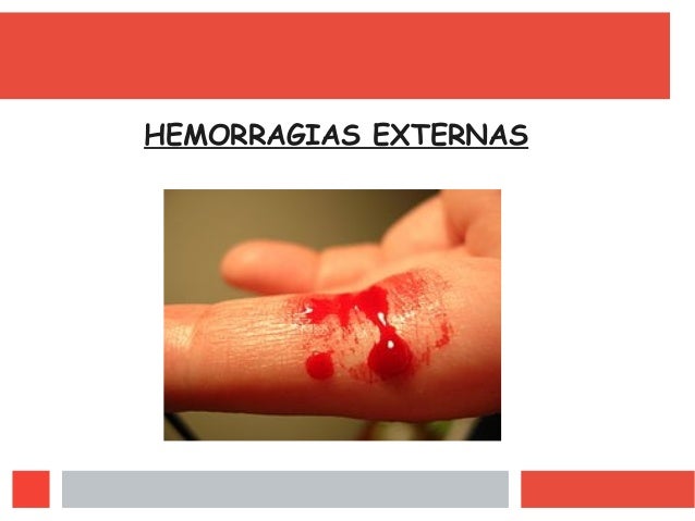 Bombeiroswaldo Hemorragia Classificao Das Hemorragias Externa