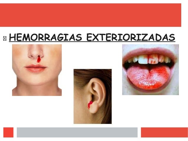 Tipos de hemorragias exteriorizadas • tiposde: hemorragias exteriorizadas pdf – BHBY