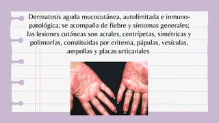 Farmacodermias eritema multiforme-Farmacologia | PPT