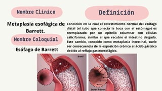 Esófago de barret y cancer esofagico Nutrición | PDF