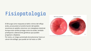 Esófago de barret y cancer esofagico Nutrición | PDF