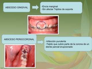 patologia: absceso periodontal | PPT