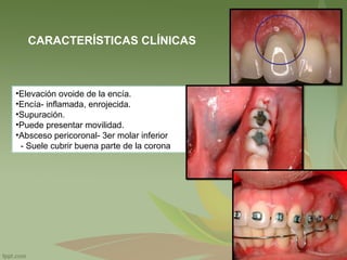 patologia: absceso periodontal | PPT