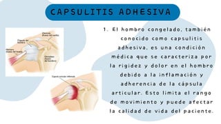 Presentación Capsulitis Adhesiva - Hombro Congelado | PDF