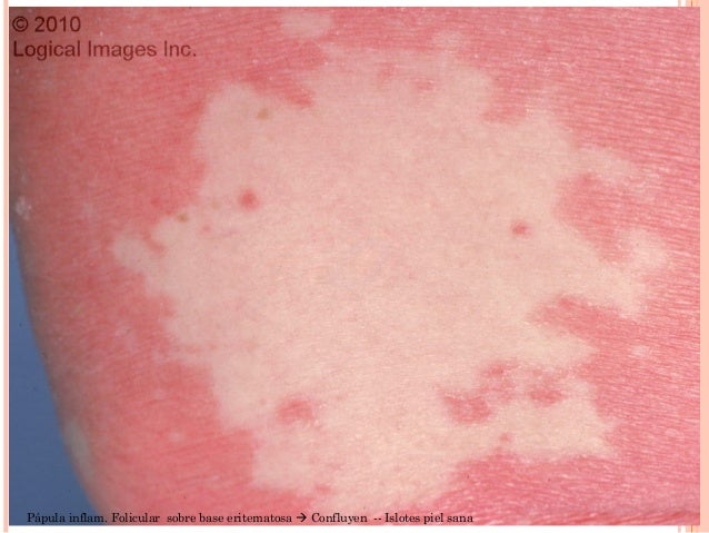 Presentacion psoriasis I