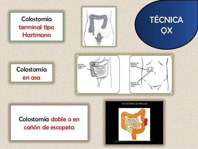 (2019 10-9) ABORDAJE INTEGRAL DEL PACIENTE COLOSTOMIZADO (ppt)
