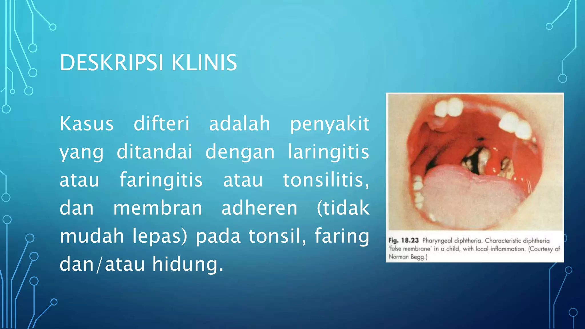 PRESENTASI DIFTERI.pptx