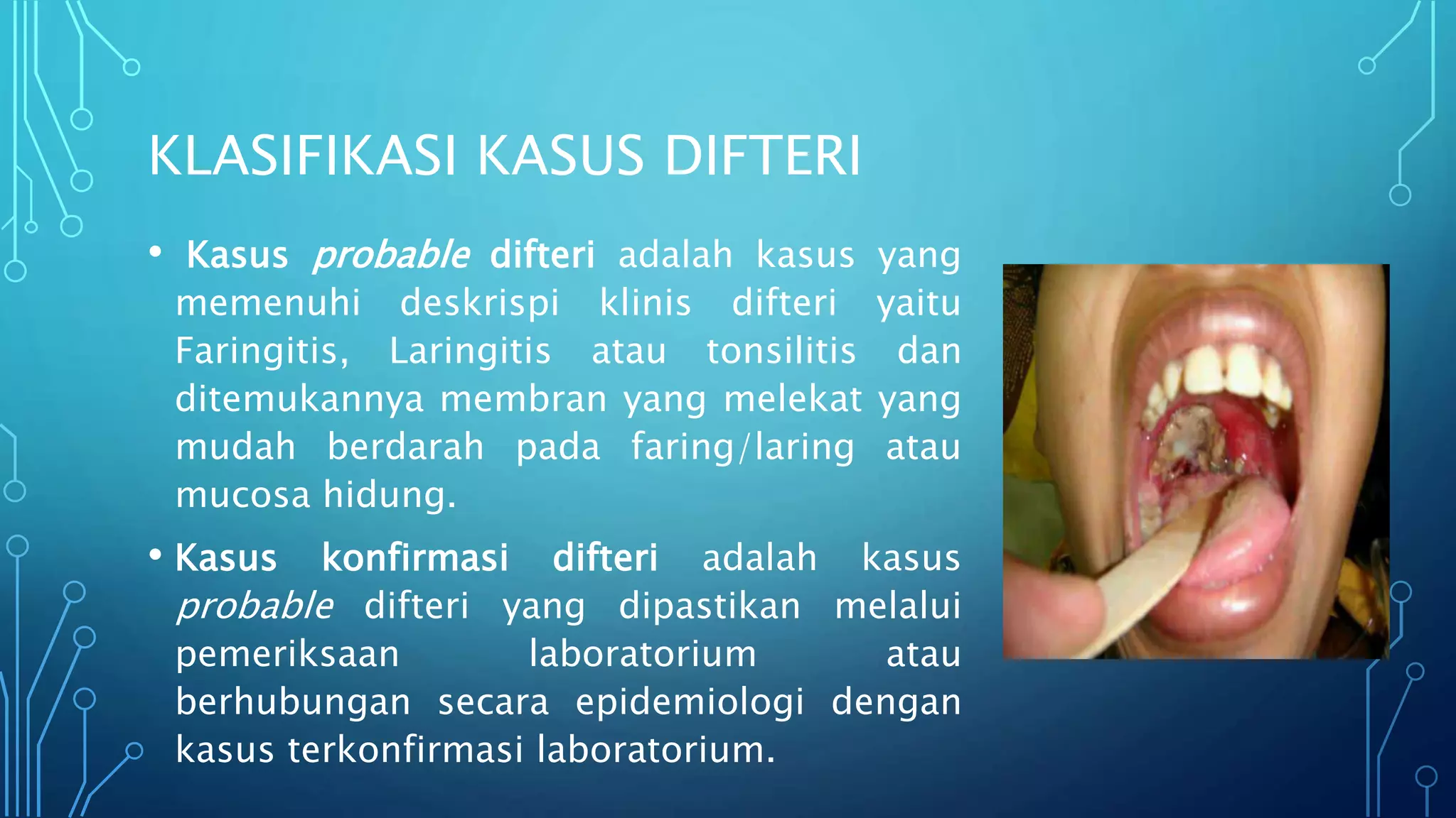 PRESENTASI DIFTERI.pptx