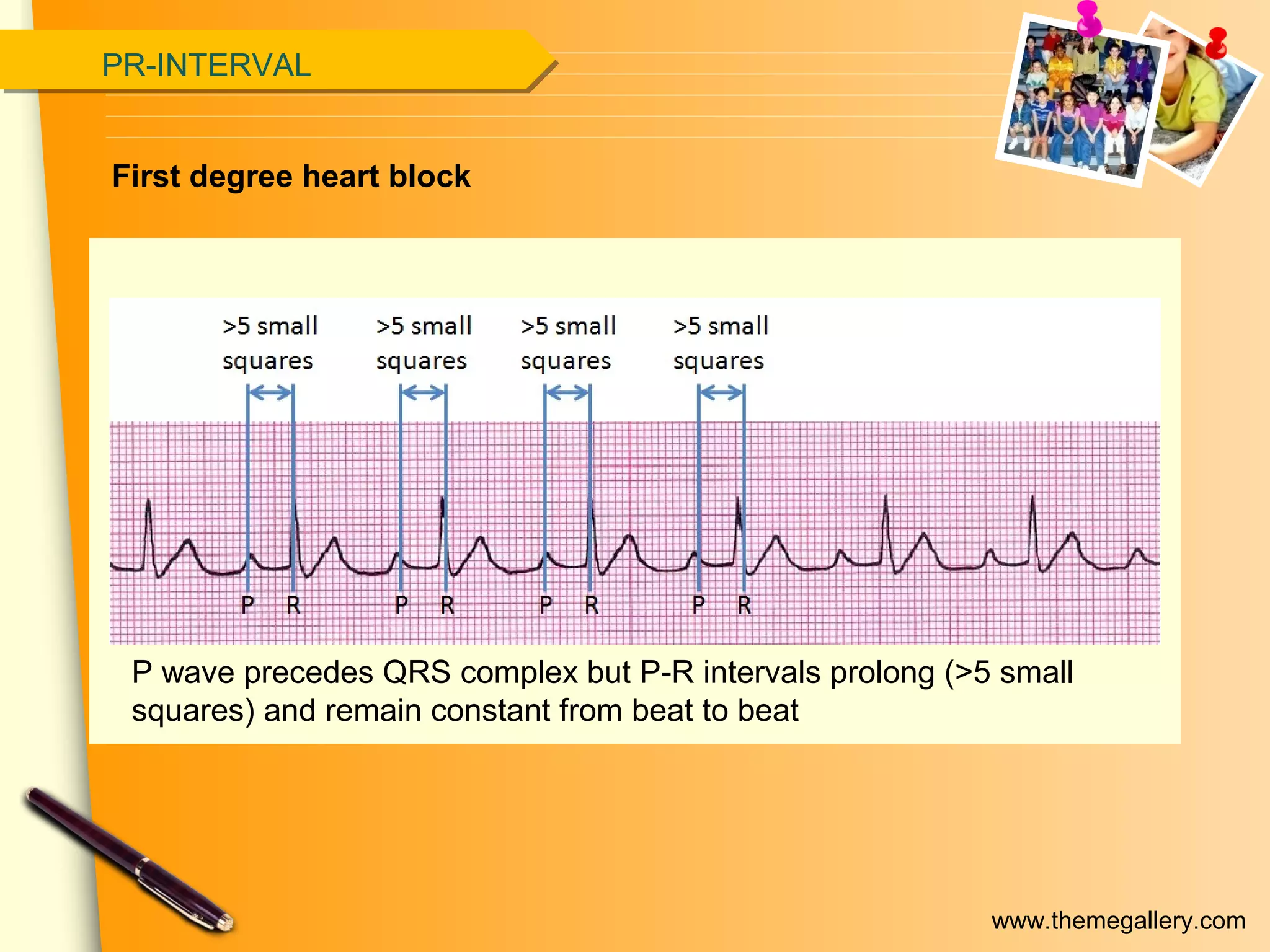 Presentasi ekg rs agung | PPT