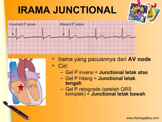 Presentasi ekg rs agung | PPT | Heart and Cardiovascular Diseases | Diseases and Conditions