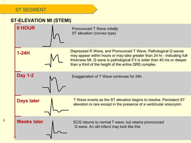 Presentasi ekg rs agung | PPT | Heart and Cardiovascular Diseases | Diseases and Conditions