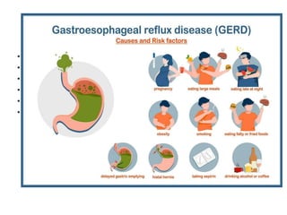 GERD ( Gastroesophageal Reflux Disease ) | PPTX