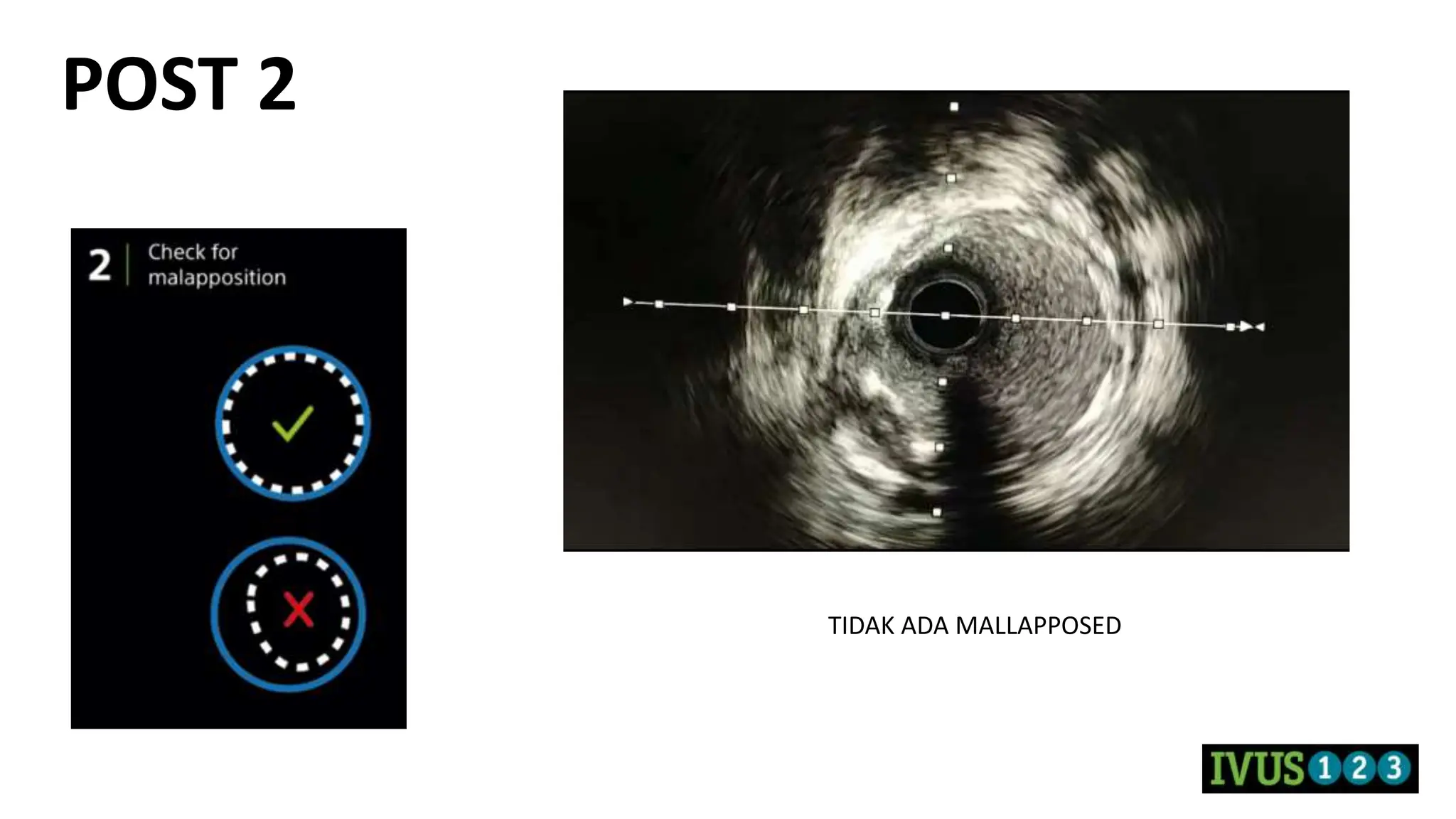 PRESENTASI INTRA VASKULAR ULTRA SOUND.pptx