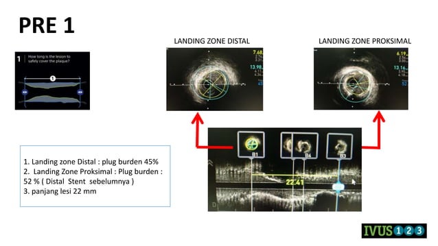 PRESENTASI INTRA VASKULAR ULTRA SOUND.pptx