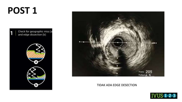 PRESENTASI INTRA VASKULAR ULTRA SOUND.pptx