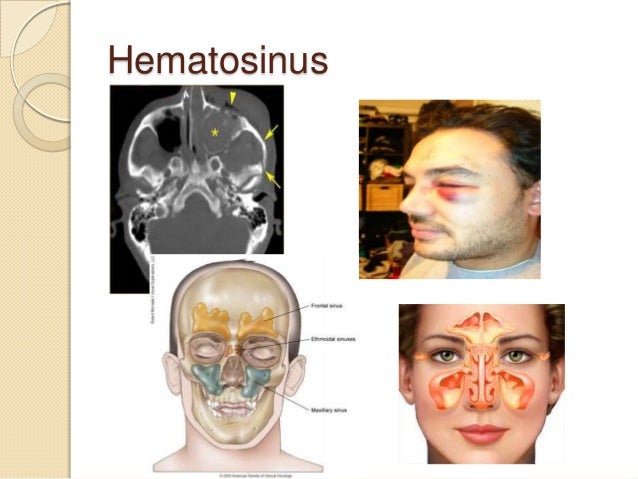 Presentasi jaka le fort ii