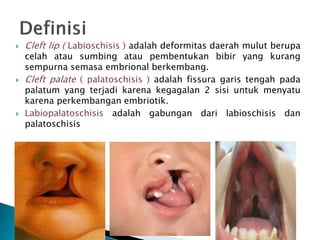 Presentasi_kasus_Labioskisis_Irving_Burh.pptx