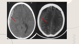 Presentasi Kasus SDH.pptx