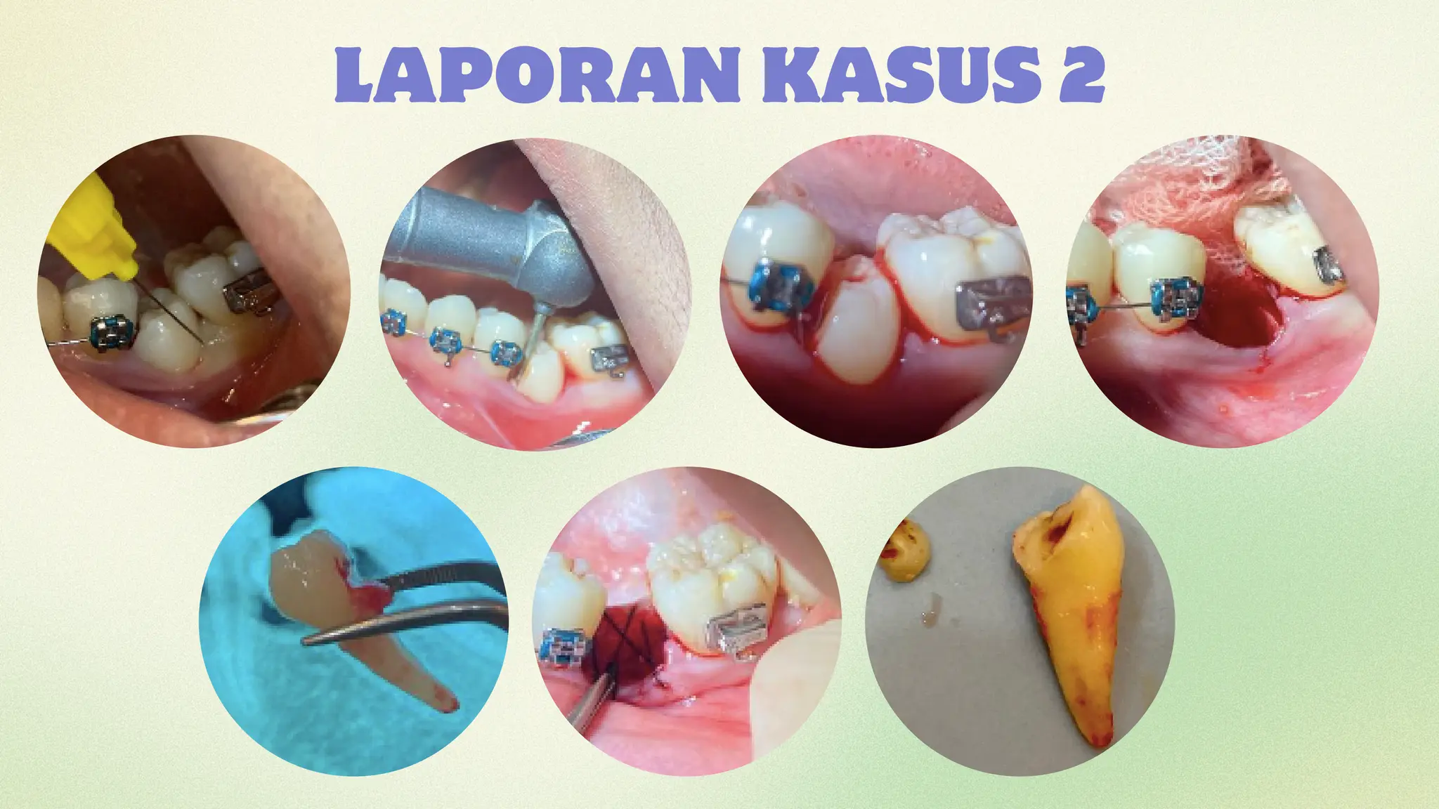 Teknik Pencabutan Gigi Atraumatik pada Berbagai kasus pencabutan gigi | PDF