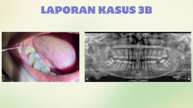 Teknik Pencabutan Gigi Atraumatik pada Berbagai kasus pencabutan gigi | PDF