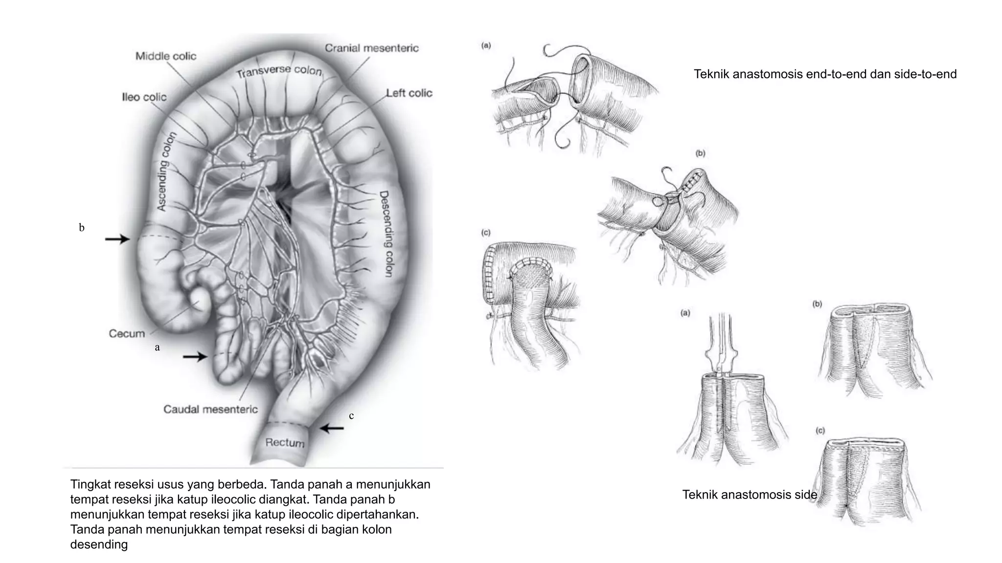 Presentasi Megakolon.pptx