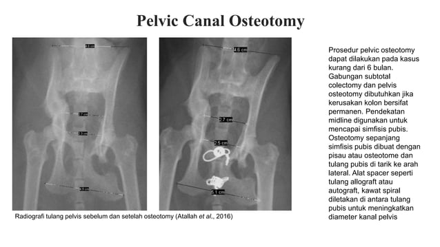 Presentasi Megakolon.pptx