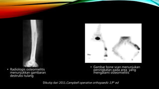 Presentasi osteomyelitis laz | PPTX