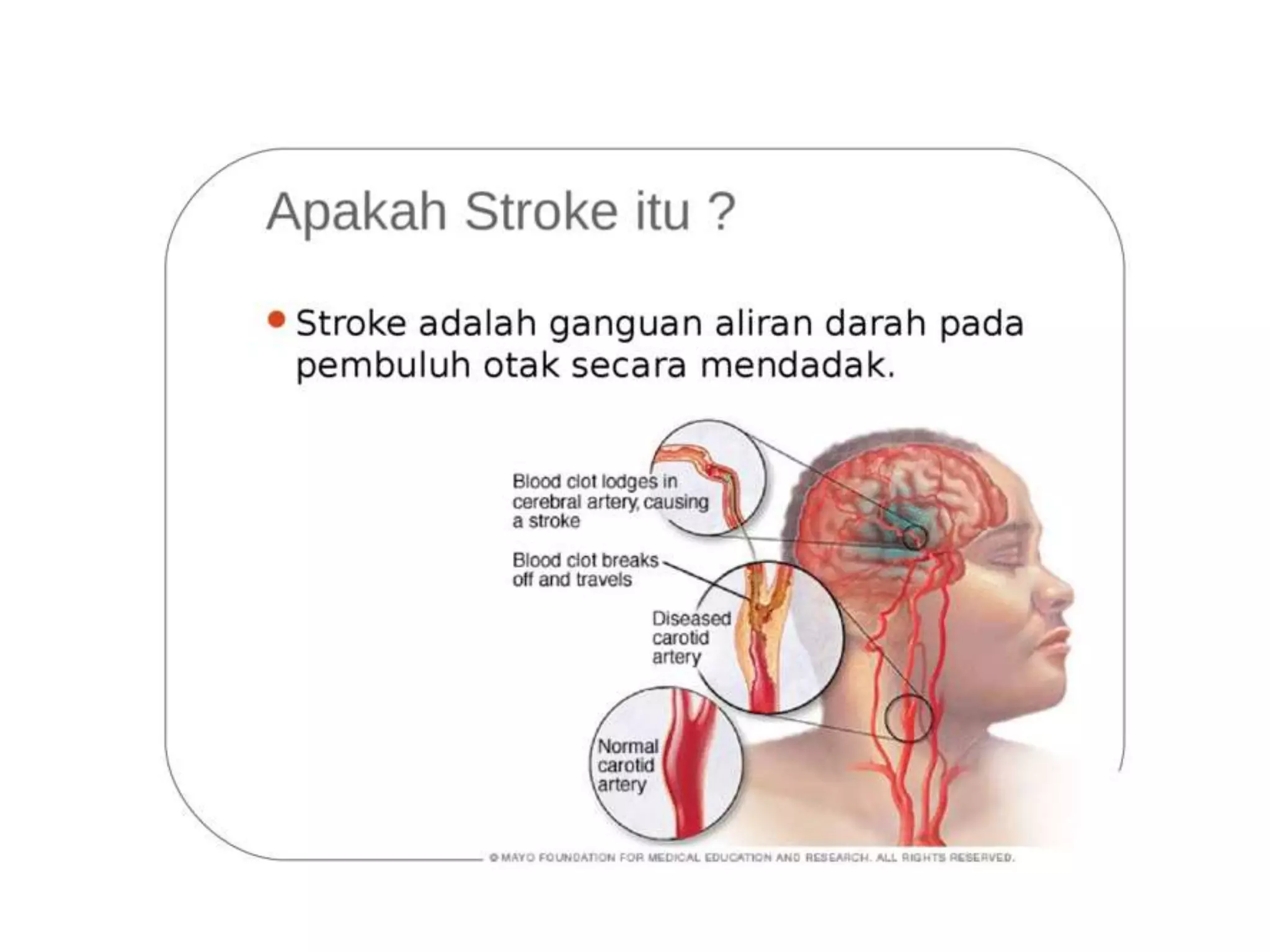 Presentasi Stroke Awam.pptx