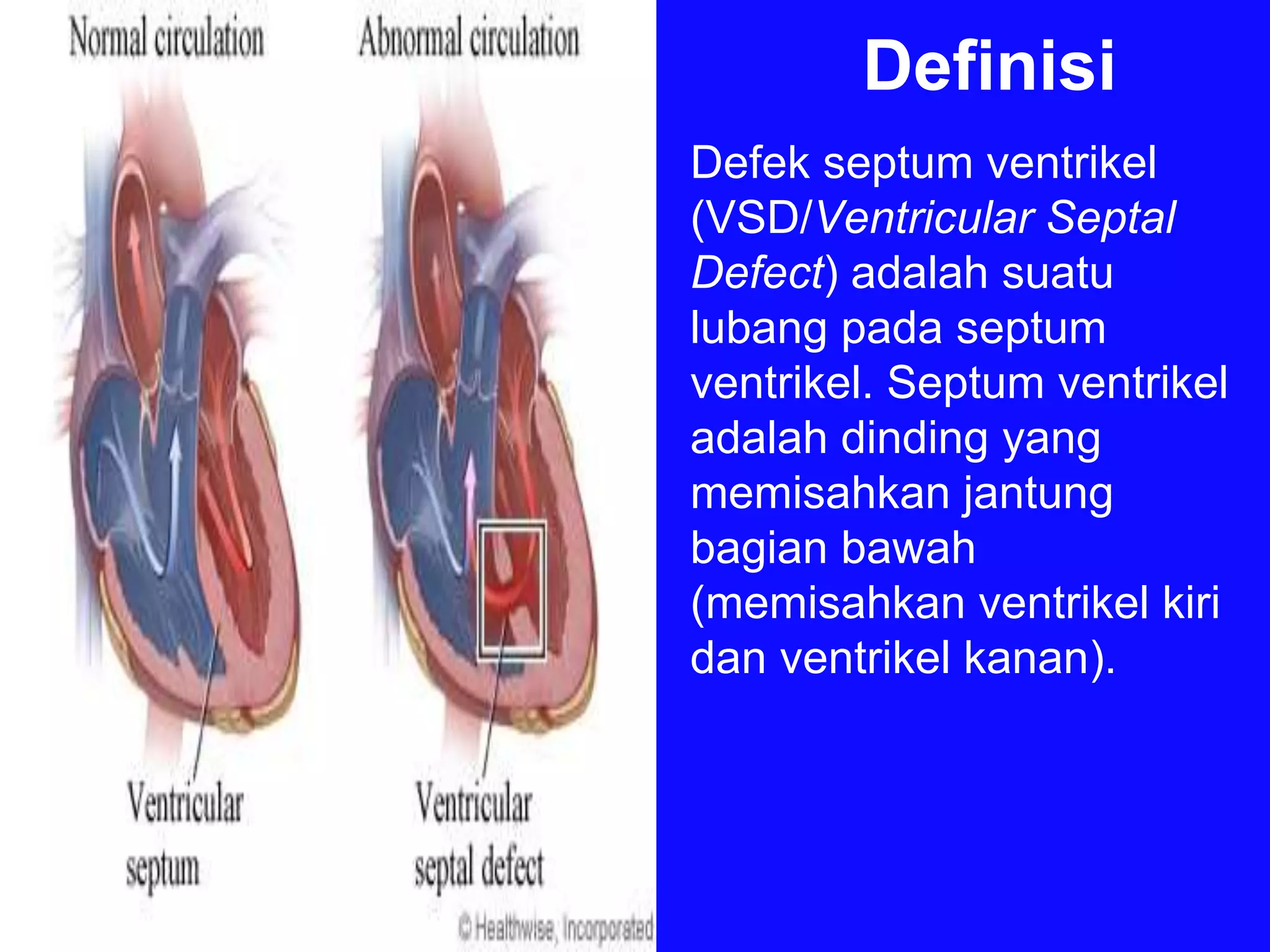 Presentasi vsd (Ventrikel septal defect) | PPTX