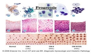 Presentatie cytologie nmdl-lcpl | PPT
