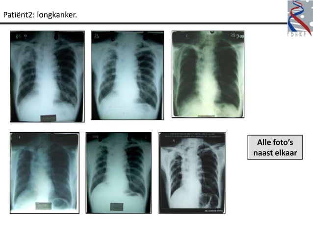 Banerji Protocols - Longkanker 2 | PPT
