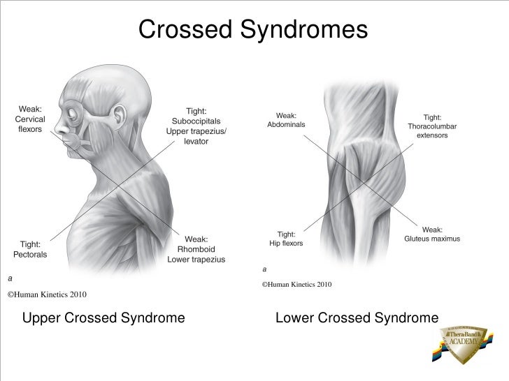 Upper And Lower Cross Syndrome