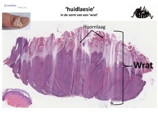 Presentatie pathologie huid_hpv_nmdl-lcpl | PPT