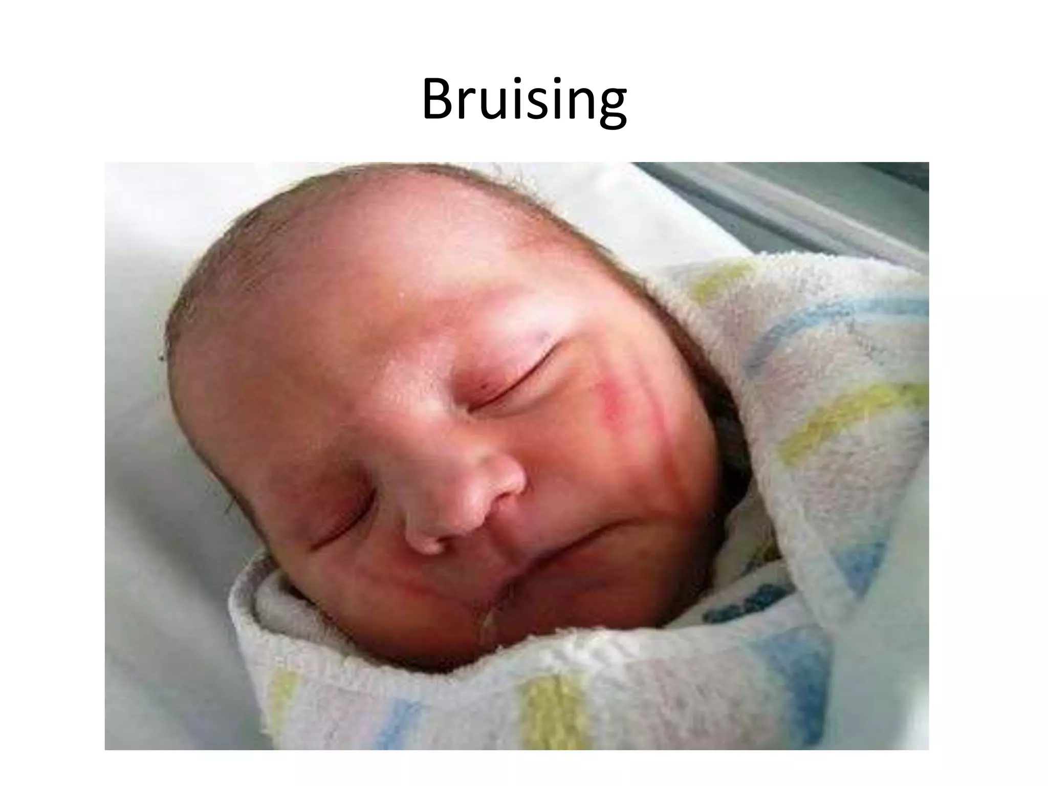 Birth Injuries | PPTX