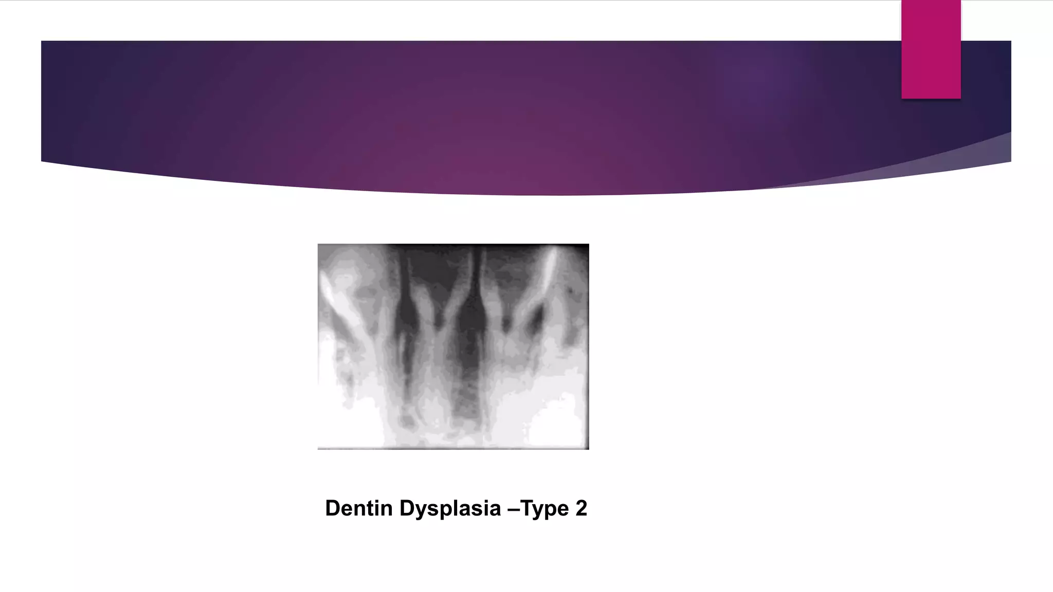 Dentin dysplasia | PPTX