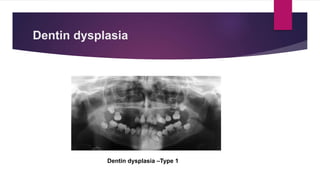 Dentin dysplasia | PPTX