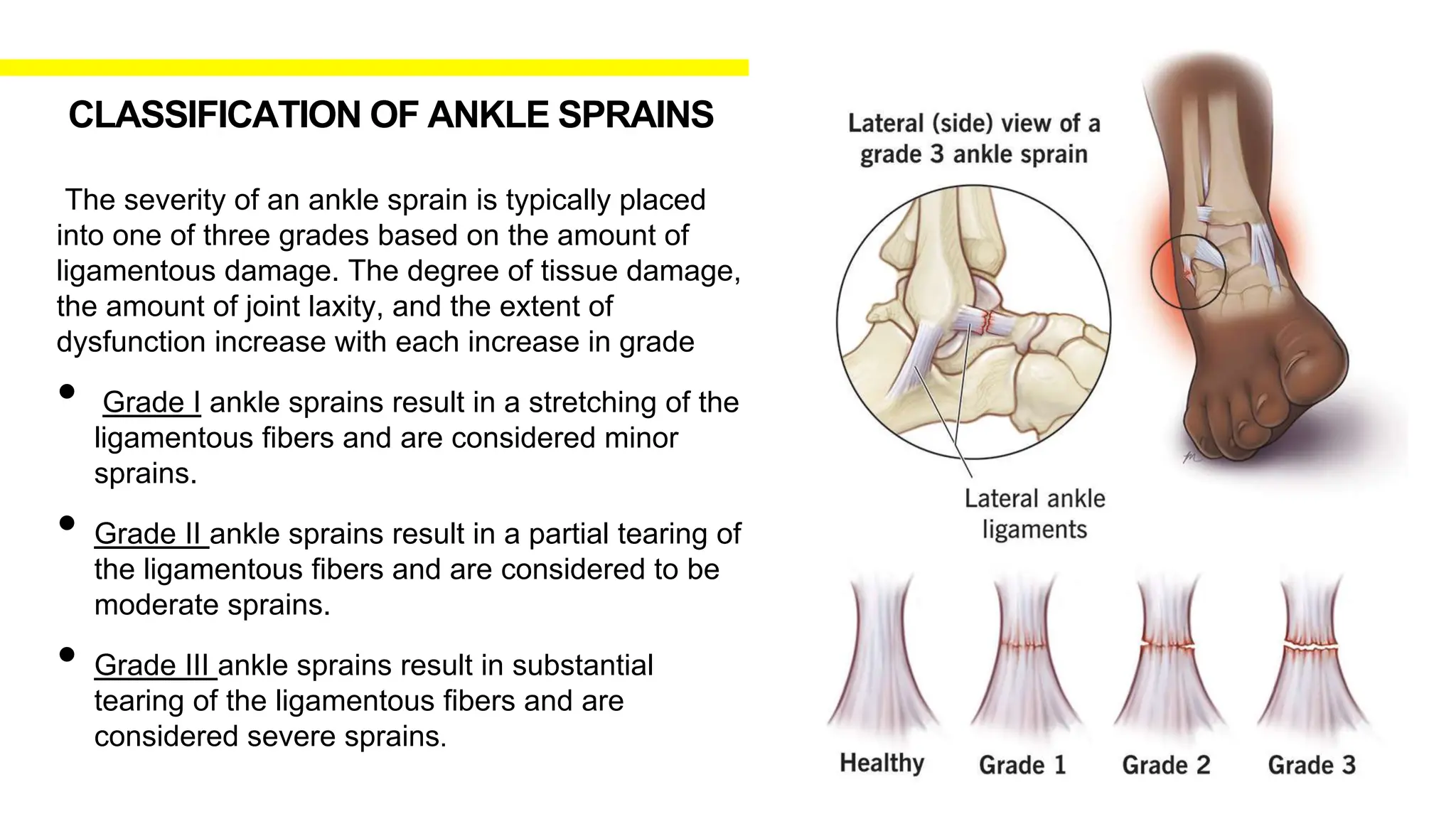 Lateral ankle sprain presentation, Details about LAS | PPTX