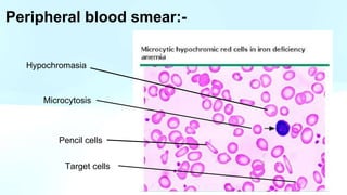Anemia in pregnancy , definition , causes , pathogenesis, management ...