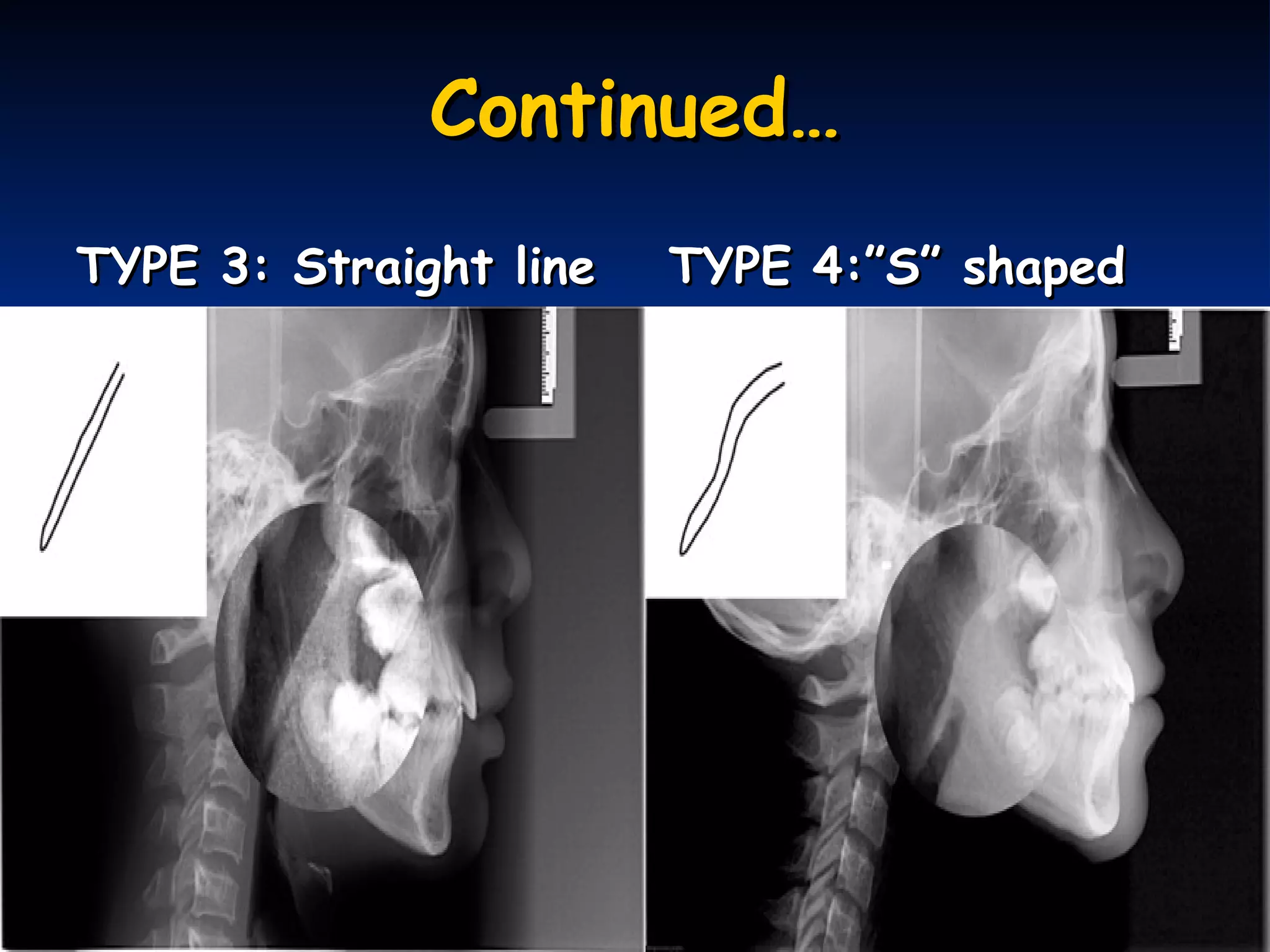 classification of soft palate and residual ridge | PPT