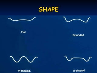 classification of soft palate and residual ridge | PPT