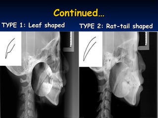 classification of soft palate and residual ridge | PPT